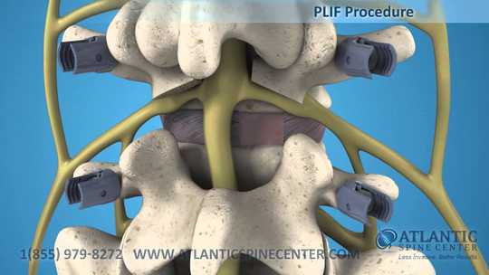 Posterior Lumbar Interbody Fusion (PLIF) Surgery | Atlantic Spine Center