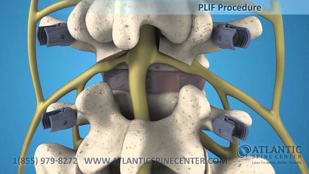 Posterior Lumbar Interbody Fusion (PLIF) Surgery | Atlantic Spine Center