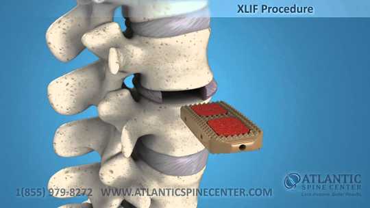 XLIF - eXtreme Lateral Interbody Fusion | Atlantic Spine Center