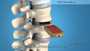 XLIF: eXtreme Lateral Interbody Fusion | Atlantic Spine Center