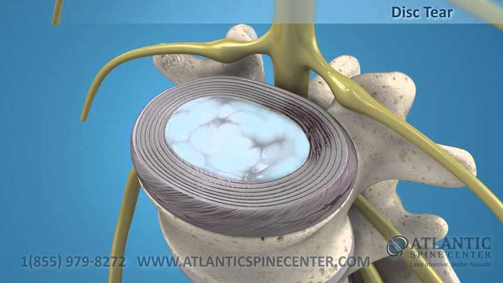 What Is a Disc Tear? | Atlantic Spine Center