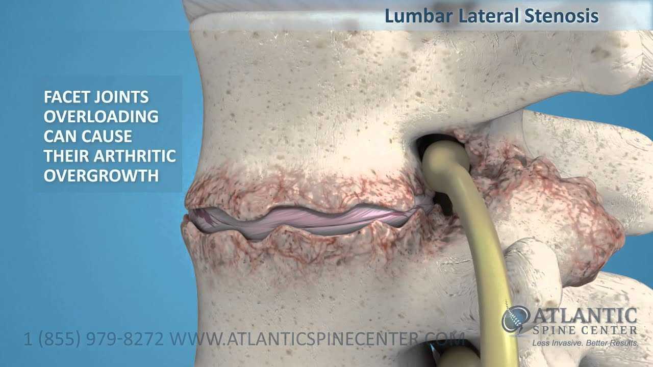 What Is Foraminal Stenosis? | Atlantic Spine Center
