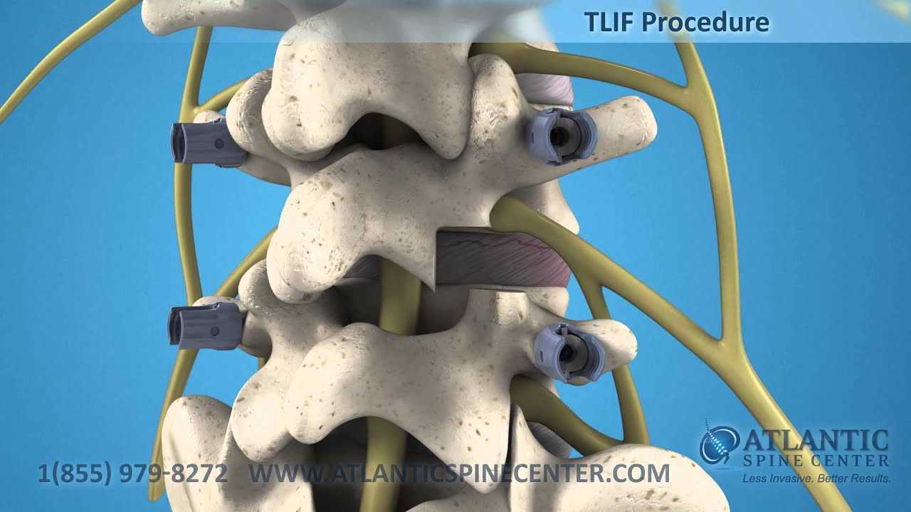 Mini Invasive Transforaminal Lumbar Interbody Fusion (Mini-TLIF ...
