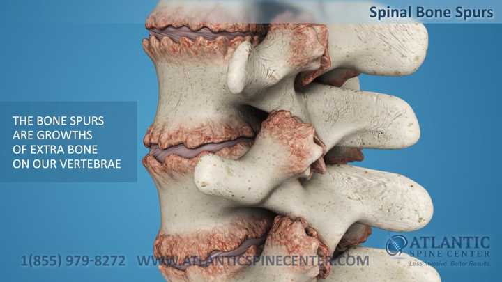 Bone Spurs — Symptoms, Causes, Diagnosis, Treatment, and Prevention ...