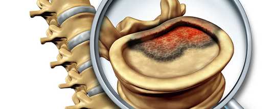 Interventional Pain Management for Cancer Pain | Atlantic Spine Center