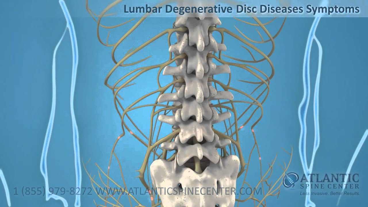 Disc Disease — Causes, Symptoms, Diagnosis, Treatment and Recovery ...