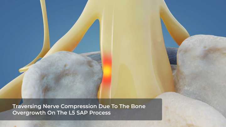 Dr. Liu Showcases New Techniques in Endoscopic Spine Surgery | Atlantic ...