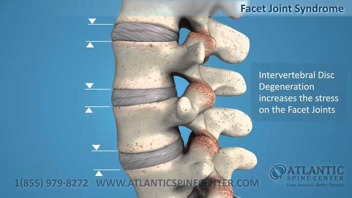 Facet Joint Block Injections | Atlantic Spine Center