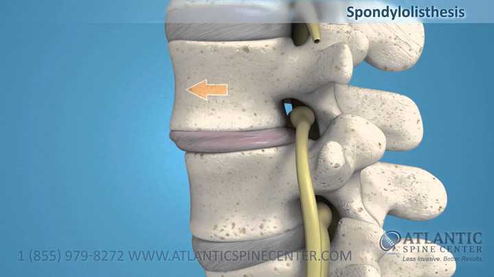 Spondylolisthesis: Symptoms, Causes, and Treatment | Atlantic Spine Center