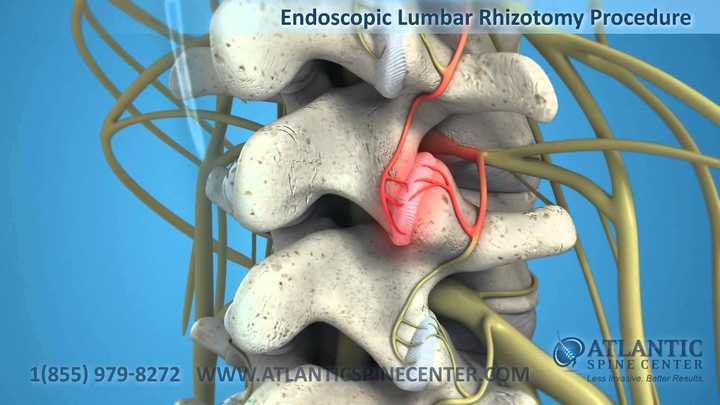 Endoscopic Facet Rhizotomy | Atlantic Spine Center