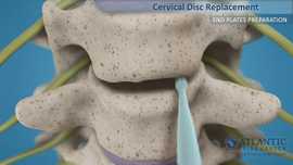 Spinal Care Video Library | Atlantic Spine Center